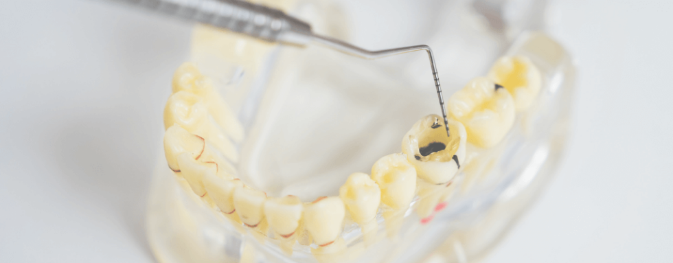 Caries radicular: ¿Qué es y cómo tratarla? | Clínica OROA